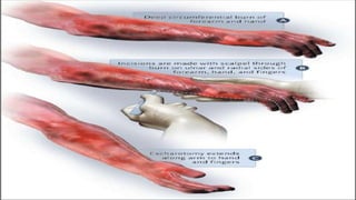 Nursing management of burn patient | PPTX