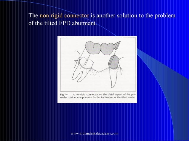 Abutment /orthodontic seminars