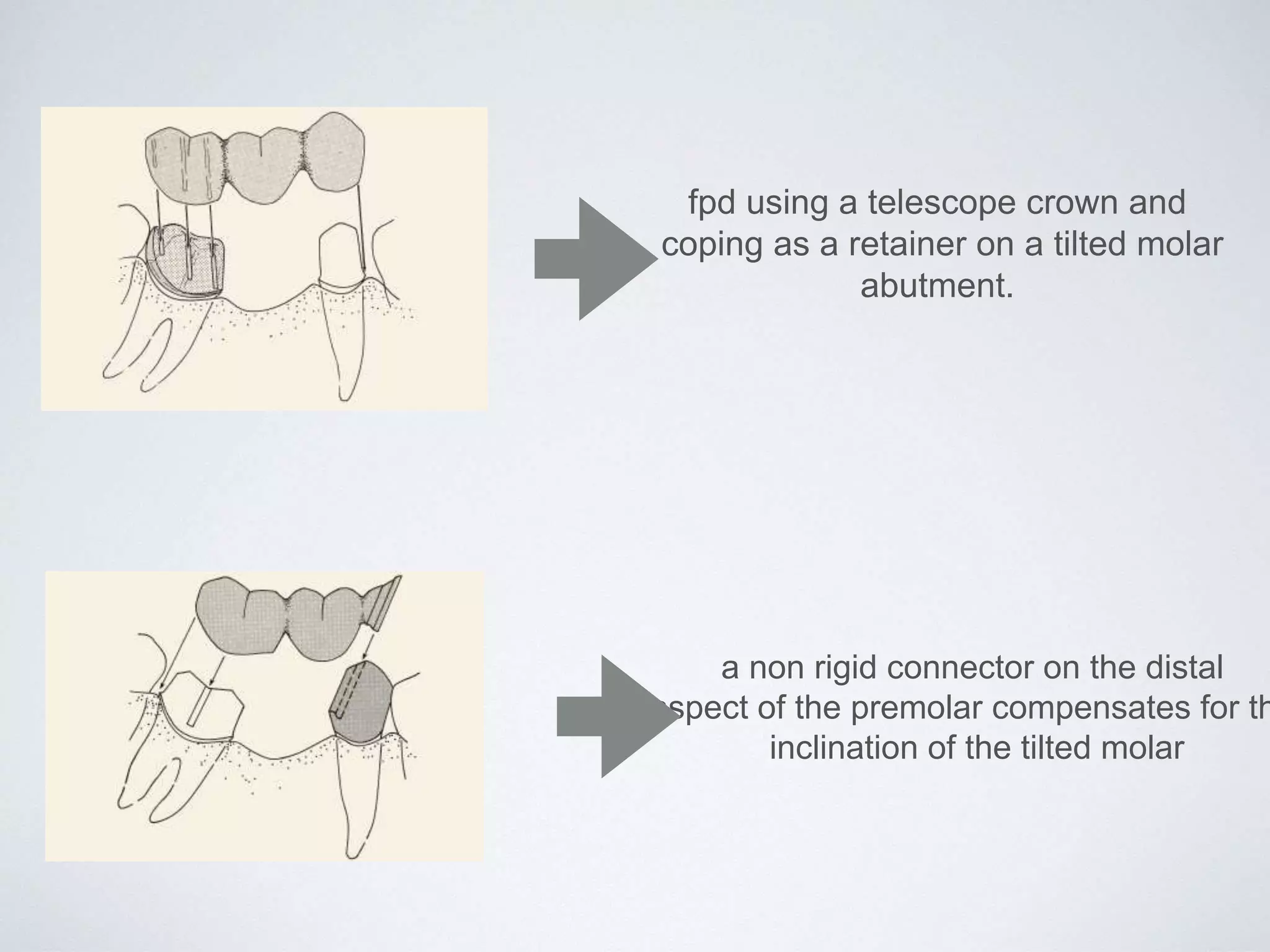 ABUTMENT EVALUATION | PPTX