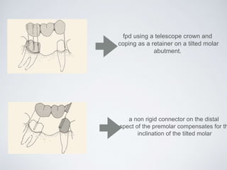 ABUTMENT EVALUATION | PPTX