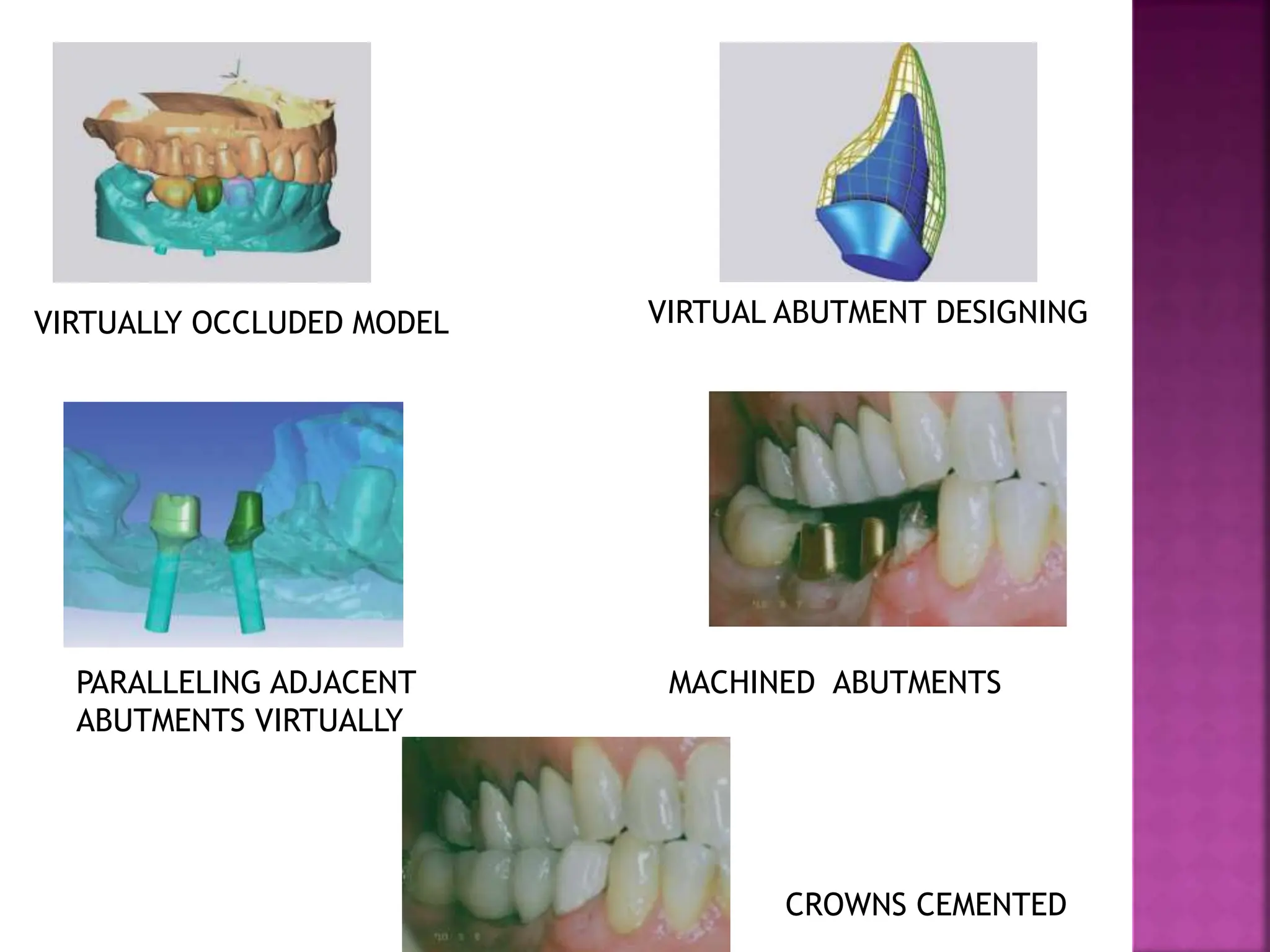 ABUTMENT SELECTION.pptx