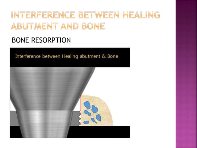 ABUTMENT SELECTION.pptx