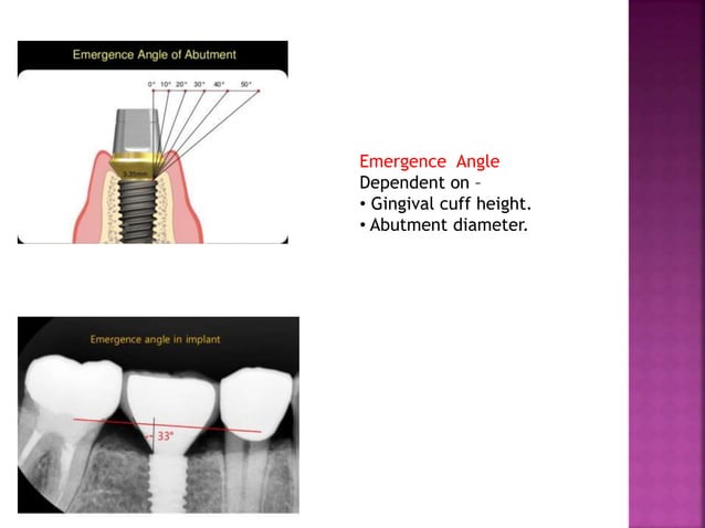 ABUTMENT SELECTION.pptx