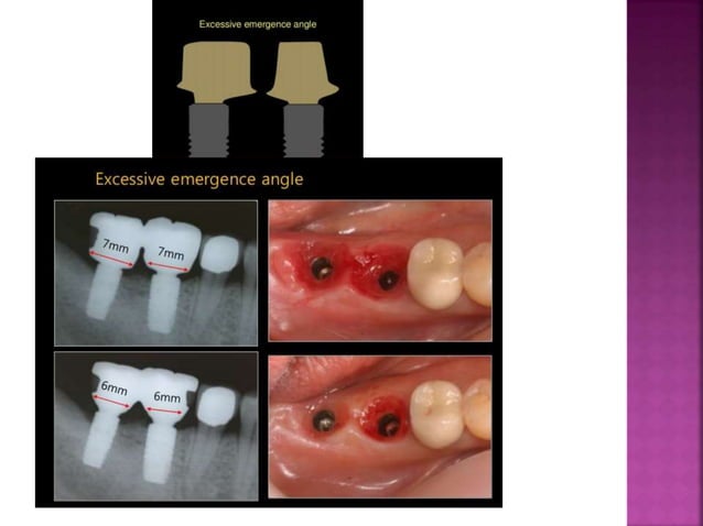 ABUTMENT SELECTION.pptx