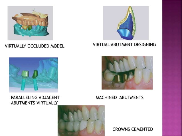 ABUTMENT SELECTION.pptx