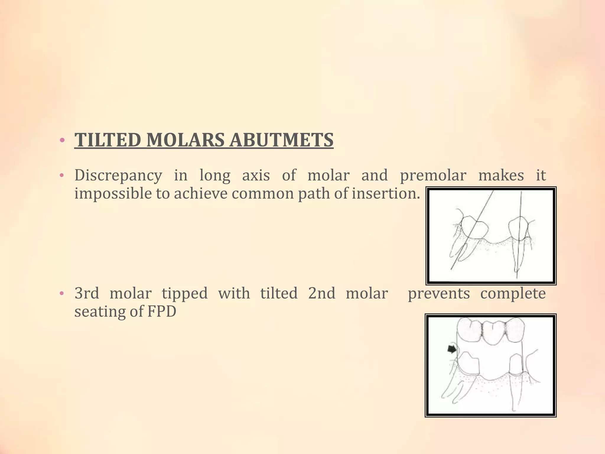 Abutment selection in FPD | PPTX