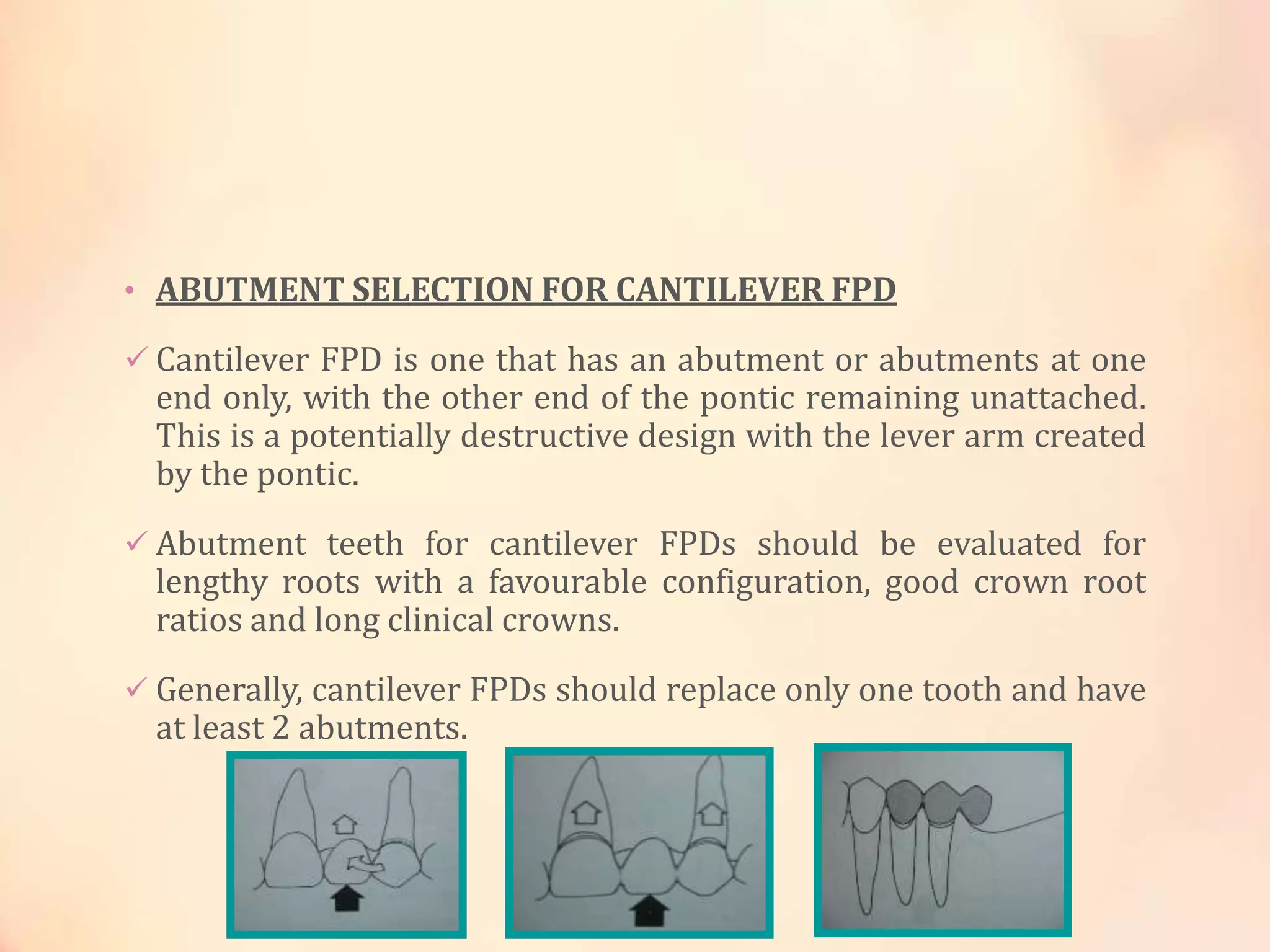 Abutment selection in FPD | PPTX