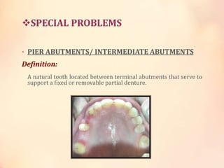Abutments Definition