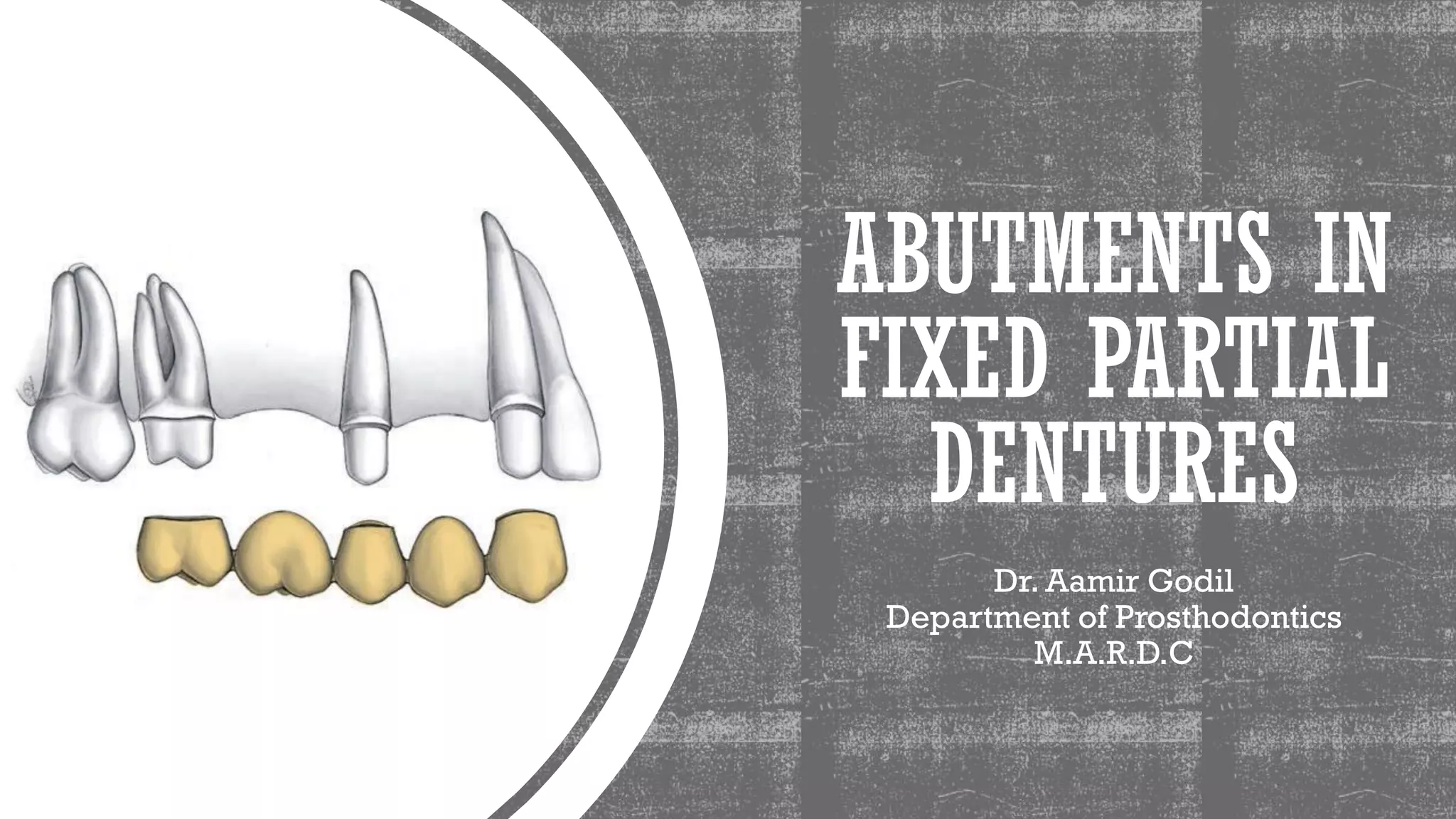 ABUTMENTS IN FIXED PARTIAL DENTURE | PDF