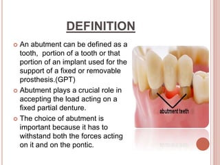 Selection of Abutment Teeth | PPT