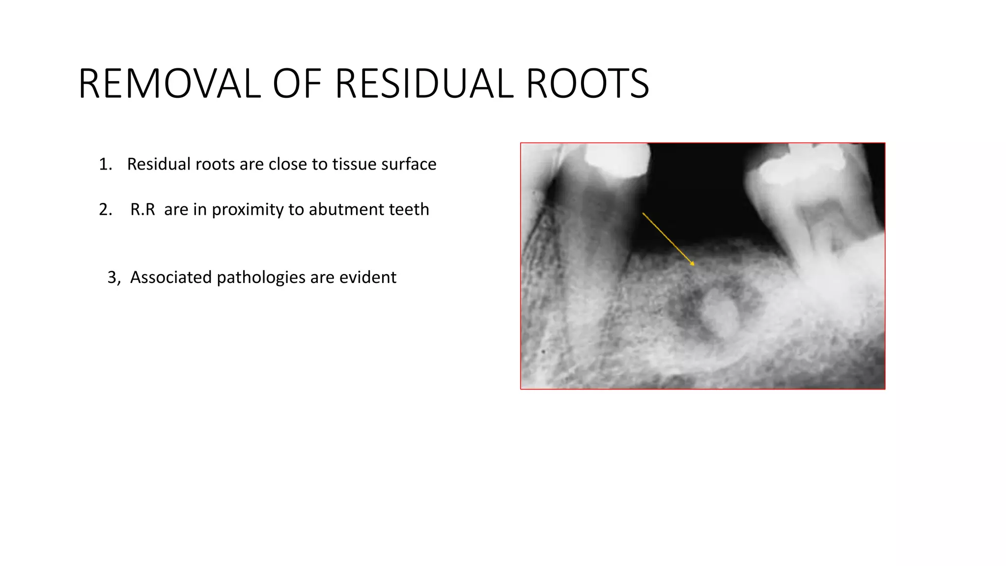 ABUTMENT TOOTH PREPARATION.pptx