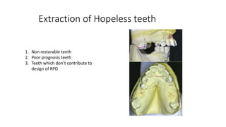 ABUTMENT TOOTH PREPARATION.pptx