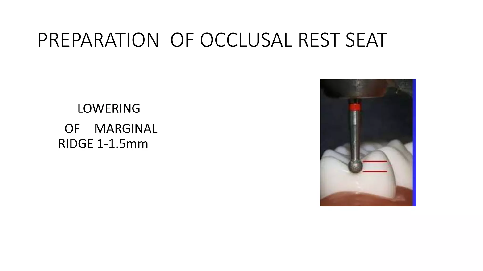 abutment tooth prep part 2.pptx