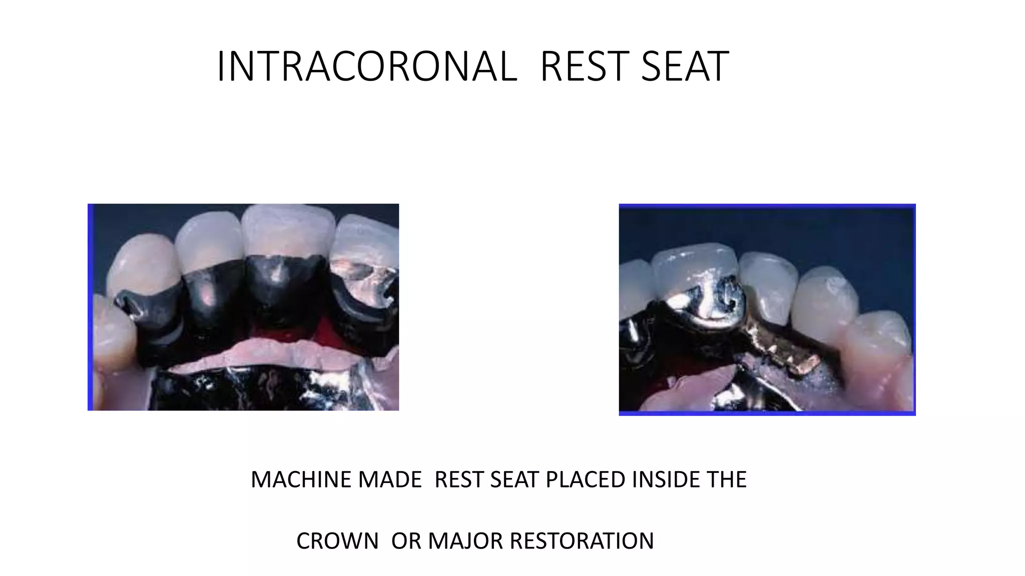 abutment tooth prep part 2.pptx