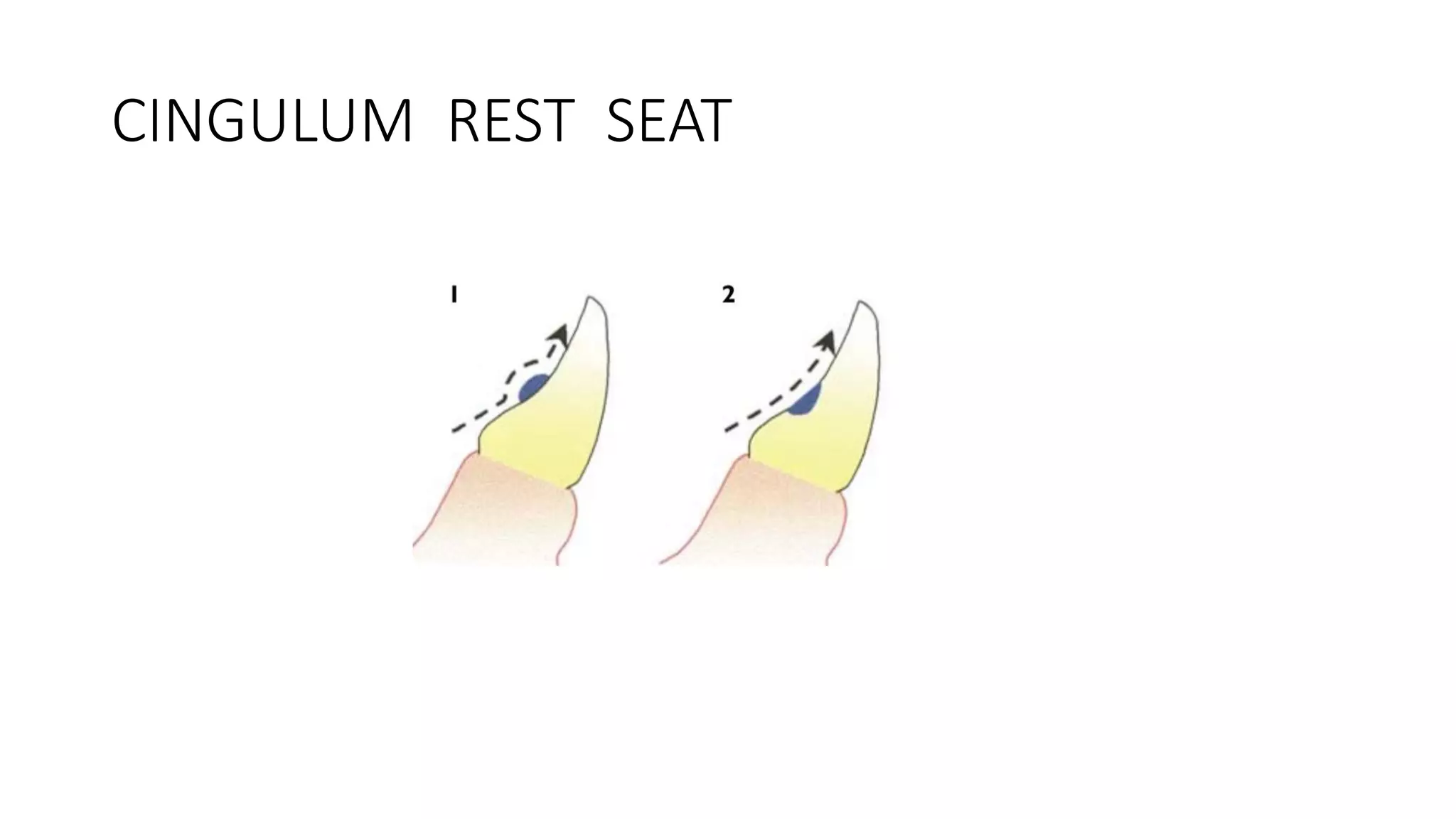 abutment tooth prep part 2.pptx