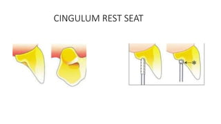 abutment tooth prep part 2.pptx