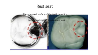 abutment tooth prep part 2.pptx