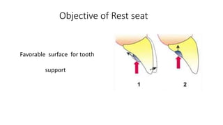 abutment tooth prep part 2.pptx