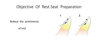 abutment tooth prep part 2.pptx