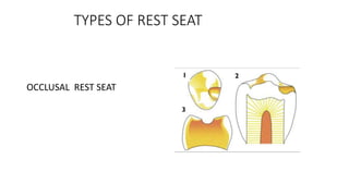 abutment tooth prep part 2.pptx
