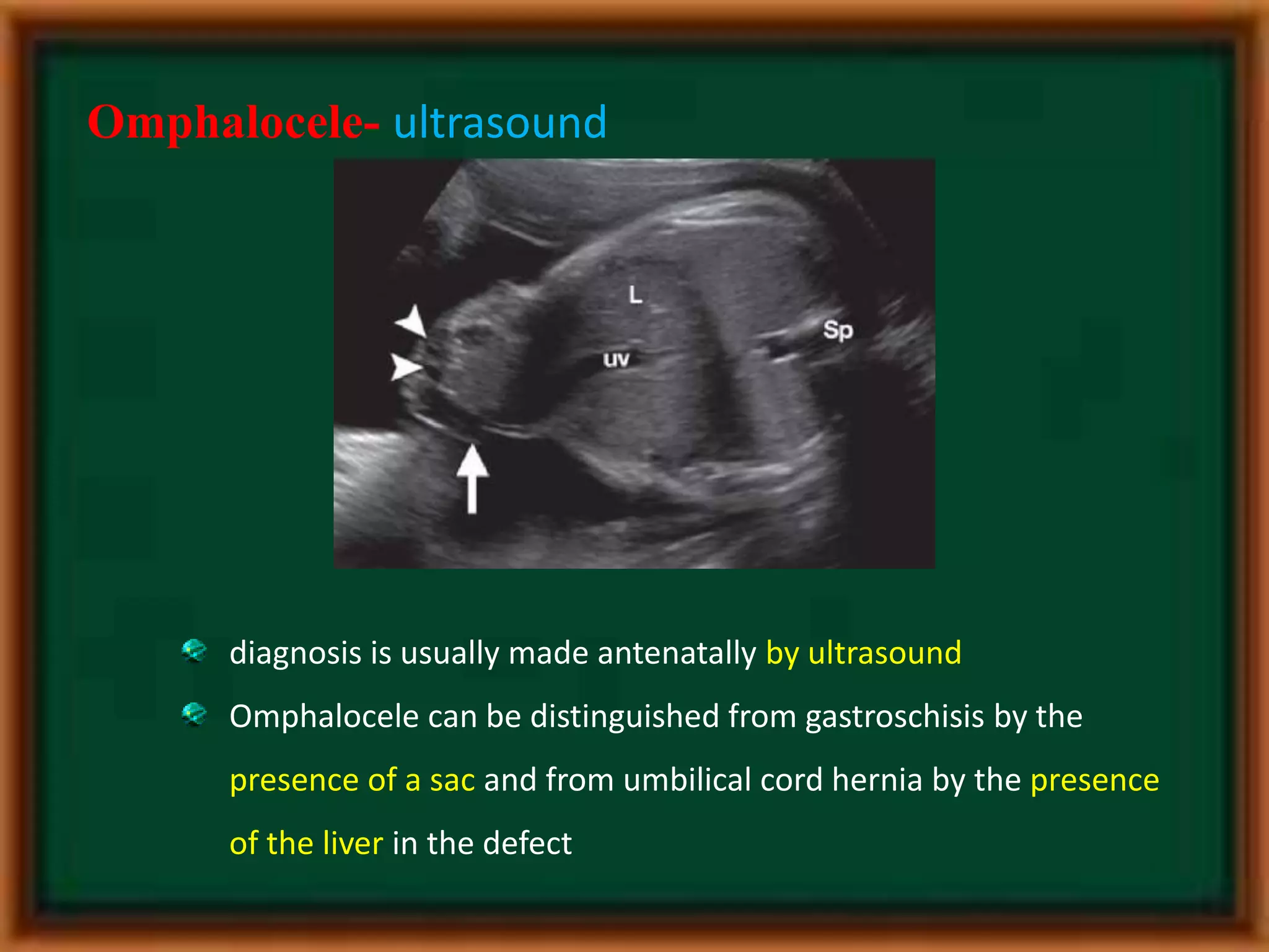 Abdominal wall defects | PPTX