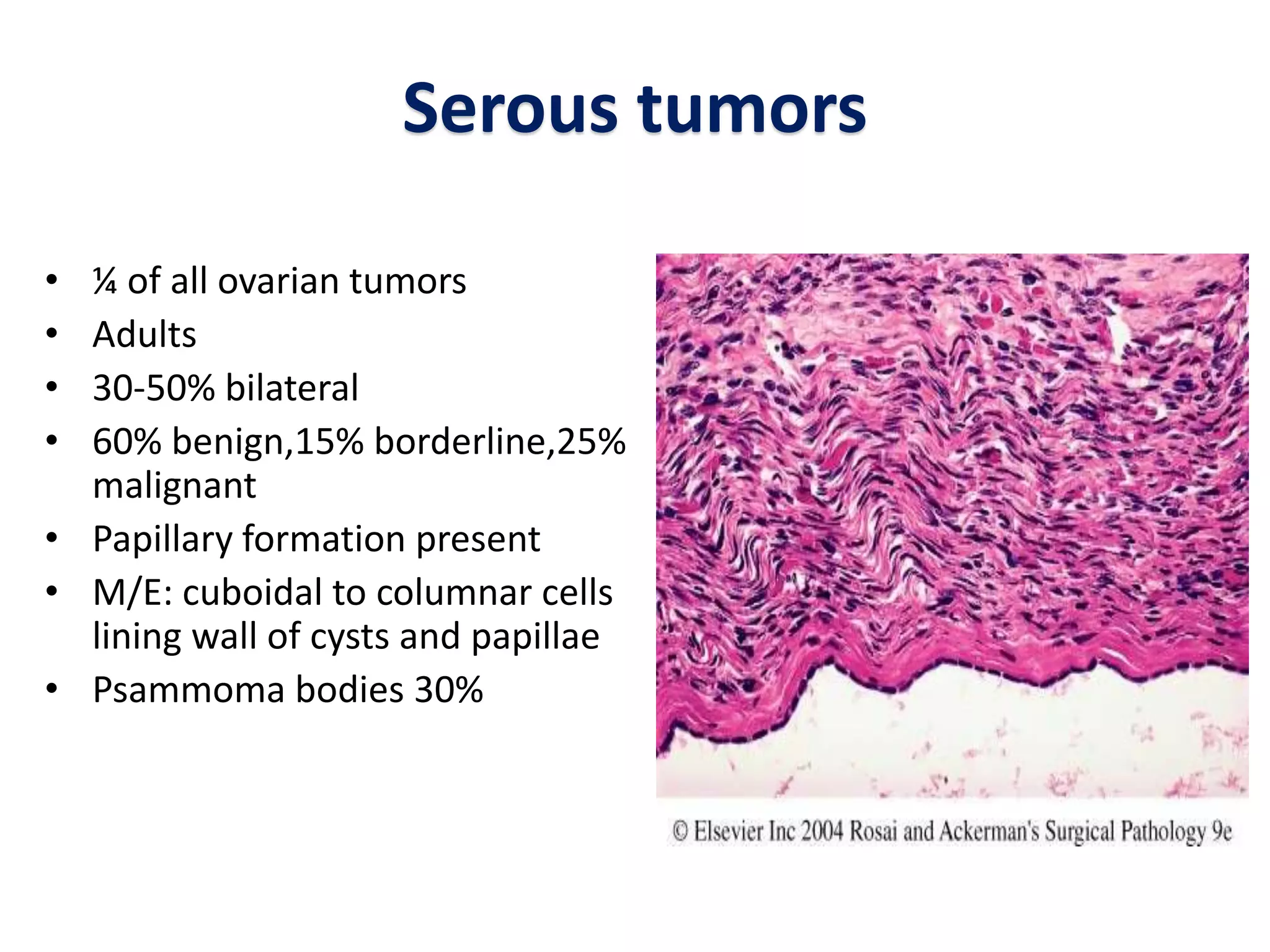 High Grade Papillary Serous Cystadenocarcinoma of Bilateral Ovaries ...
