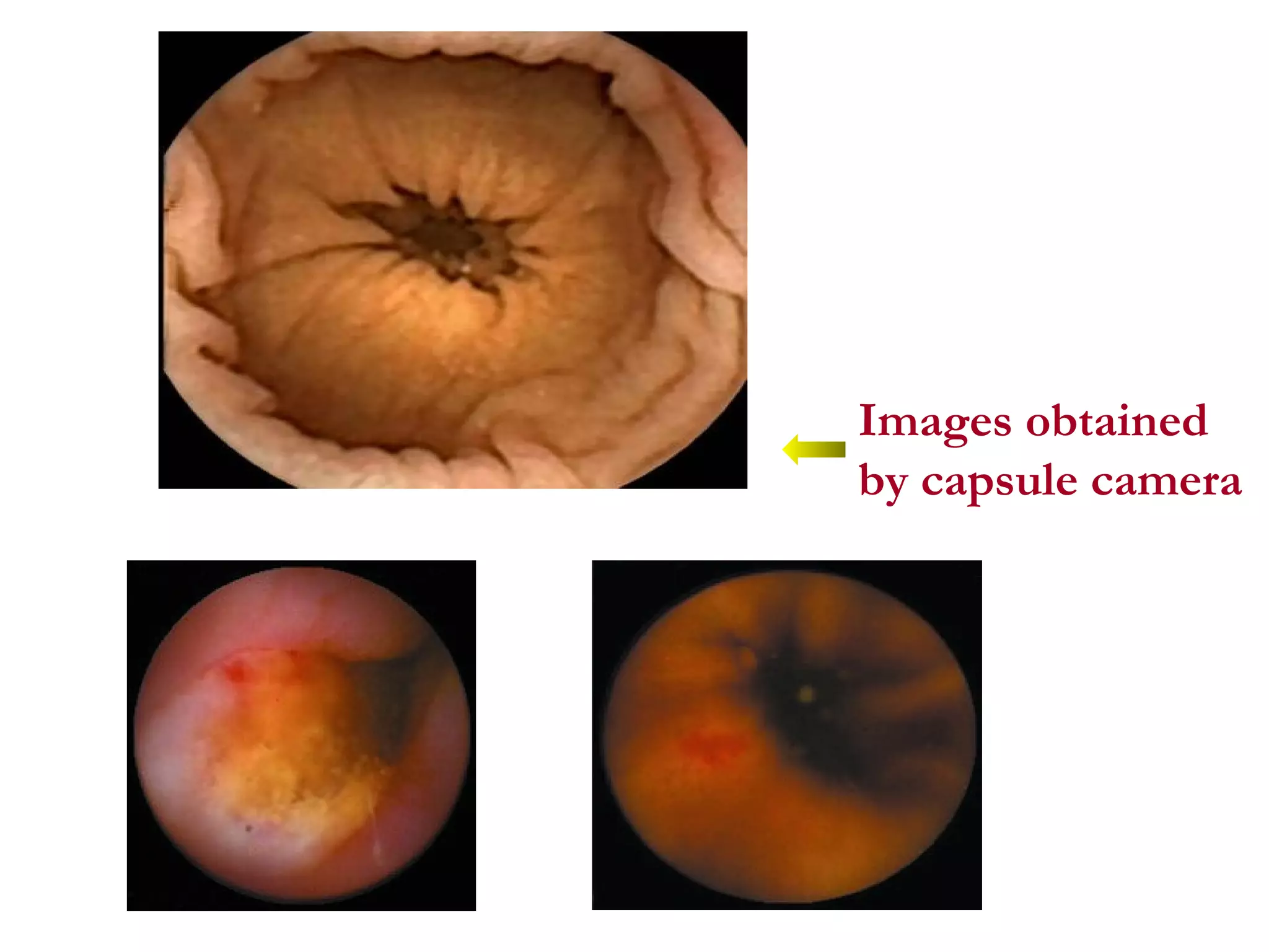 Pill Camera ppt | PPT