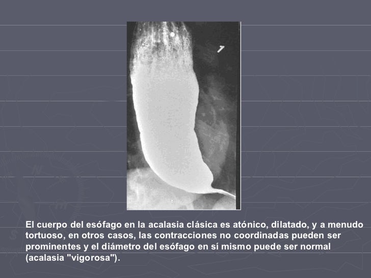 Acalasia esofagica