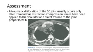 Acromioclavicular and sternoclavicular joint injuries.pptx
