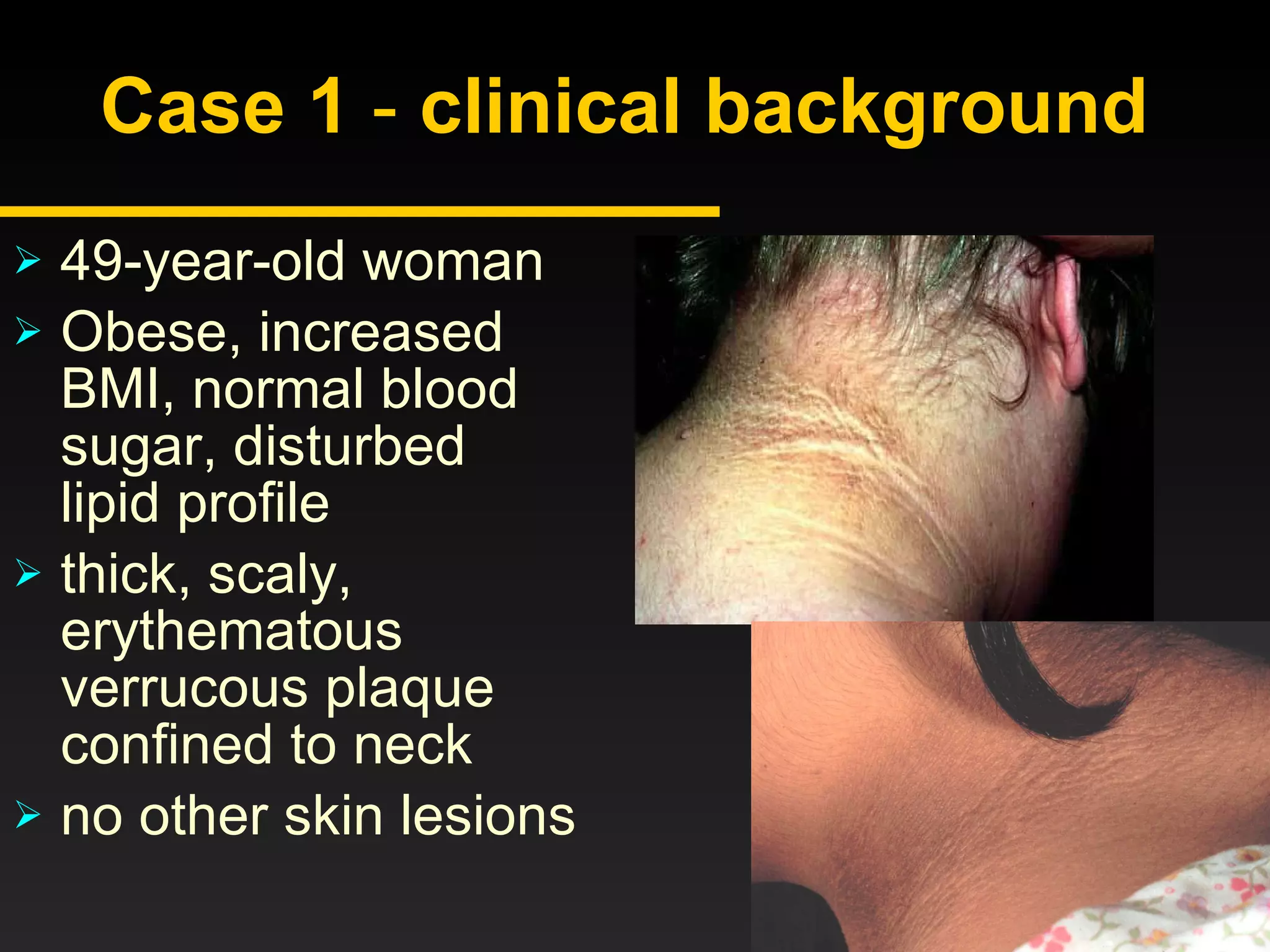 Acanthosis nigricans | PPT