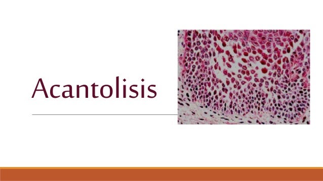Acantolisis
