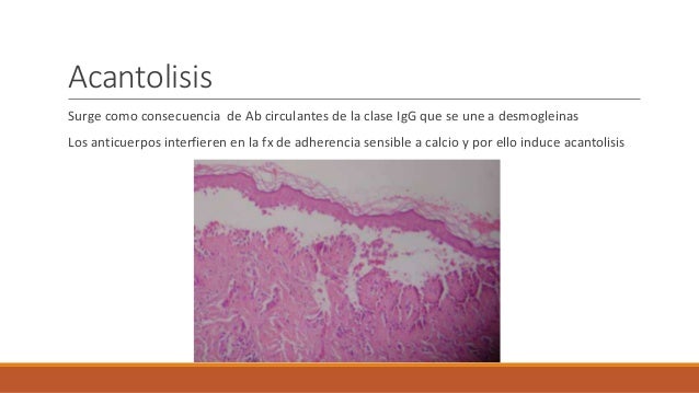 Acantolisis