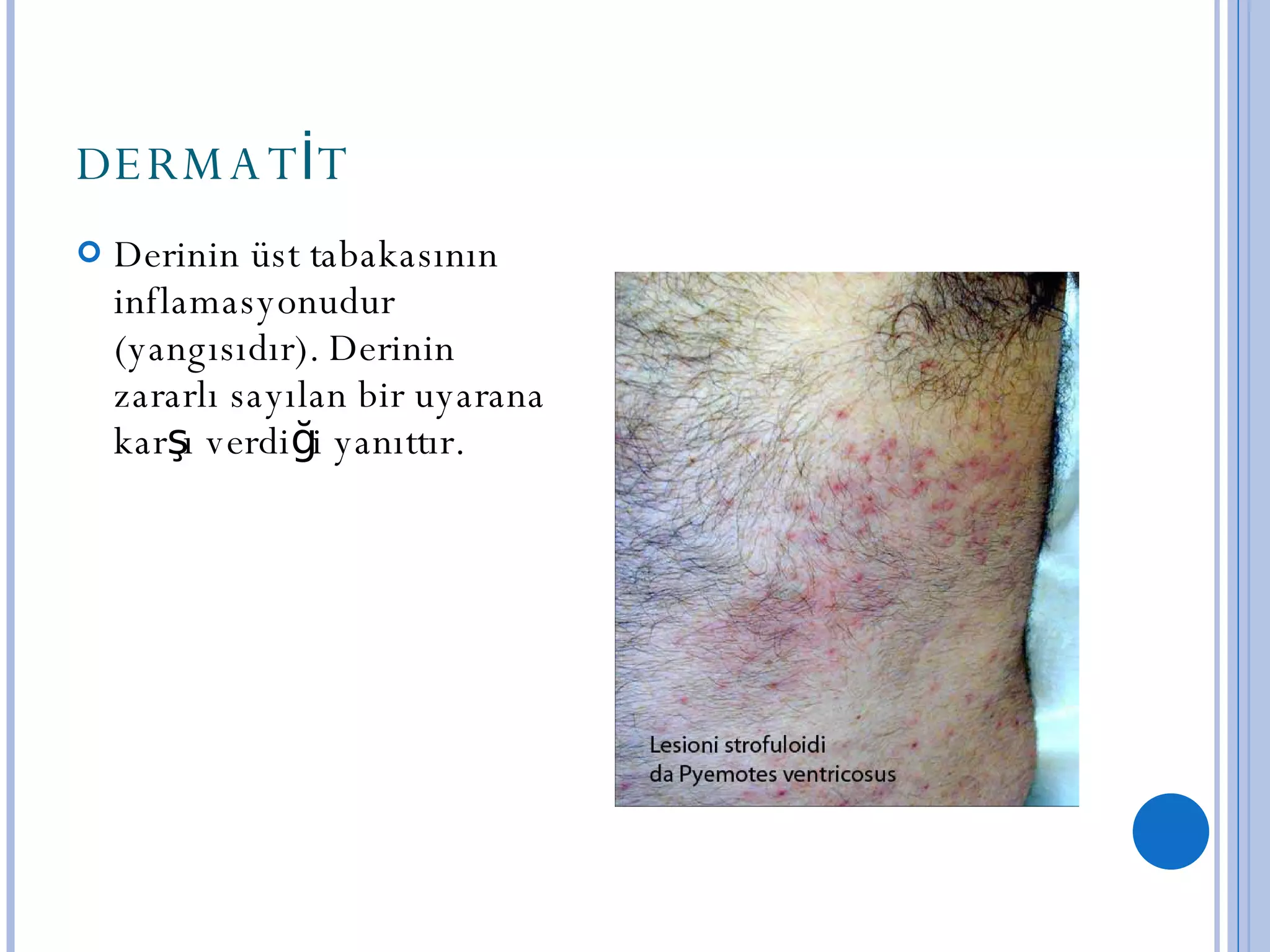 Acarodermatitis Urticarioides | PPS