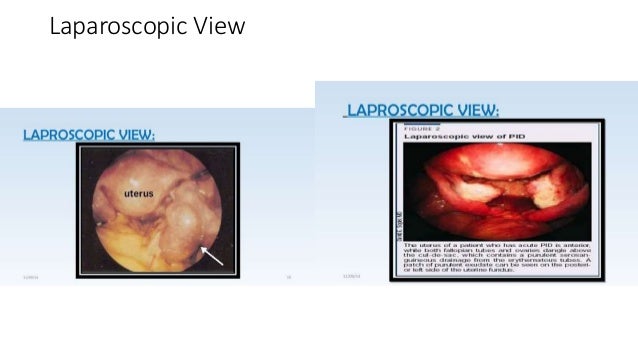 A case of acute Pelvic Inflammatory Disease (PID)