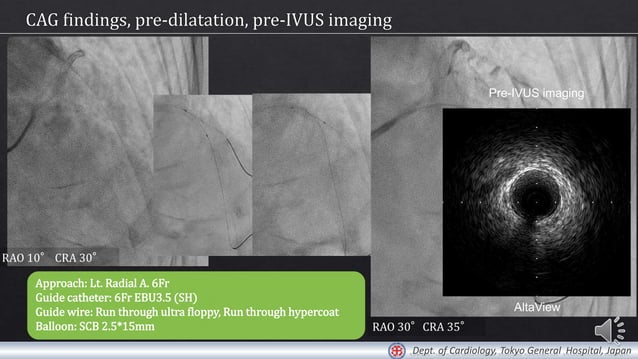 A case of anterior NSTEMI with displacement of the 3rd generation SES.pptx