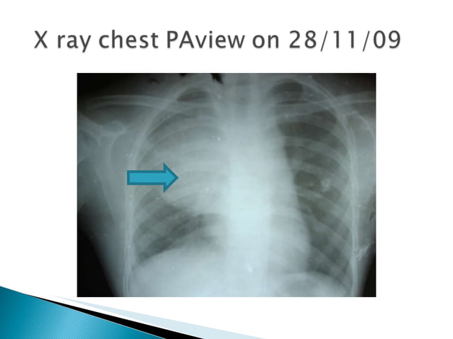 A Case of Chylothorax | PPT