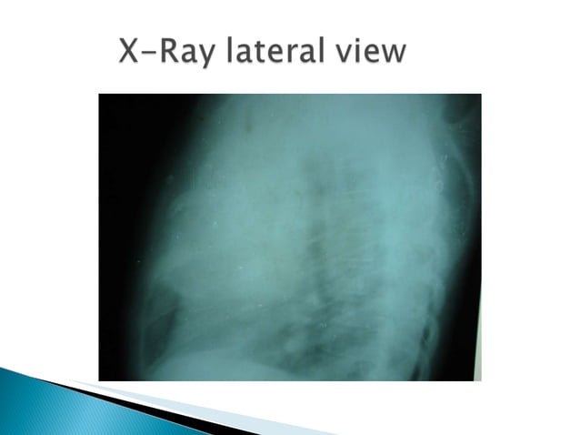 A Case of Chylothorax | PPT