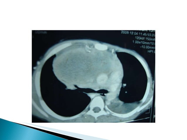 A Case of Chylothorax | PPT