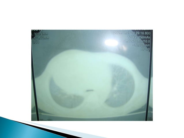 A Case of Chylothorax | PPT