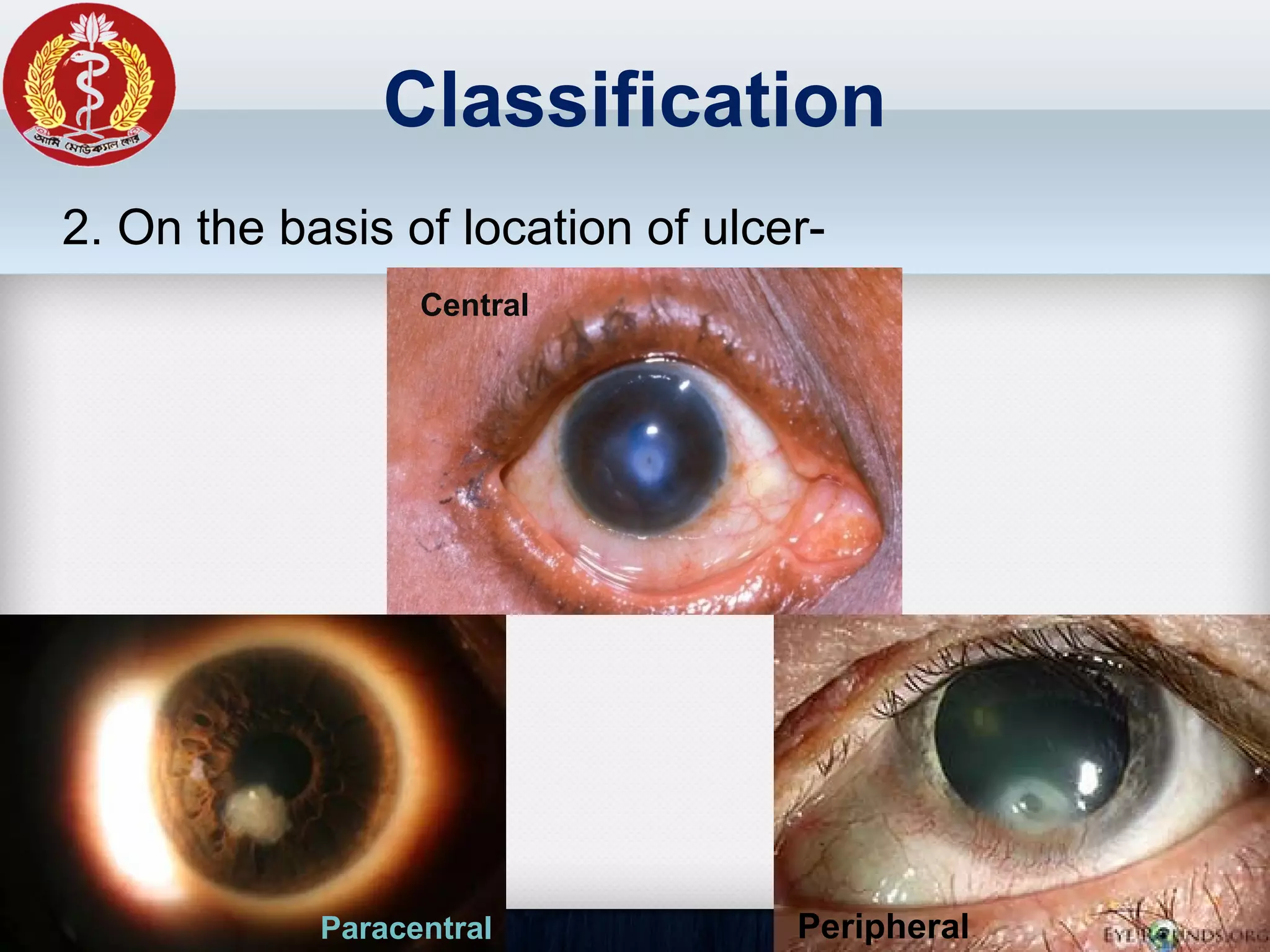 Corneal Ulcer | PPT