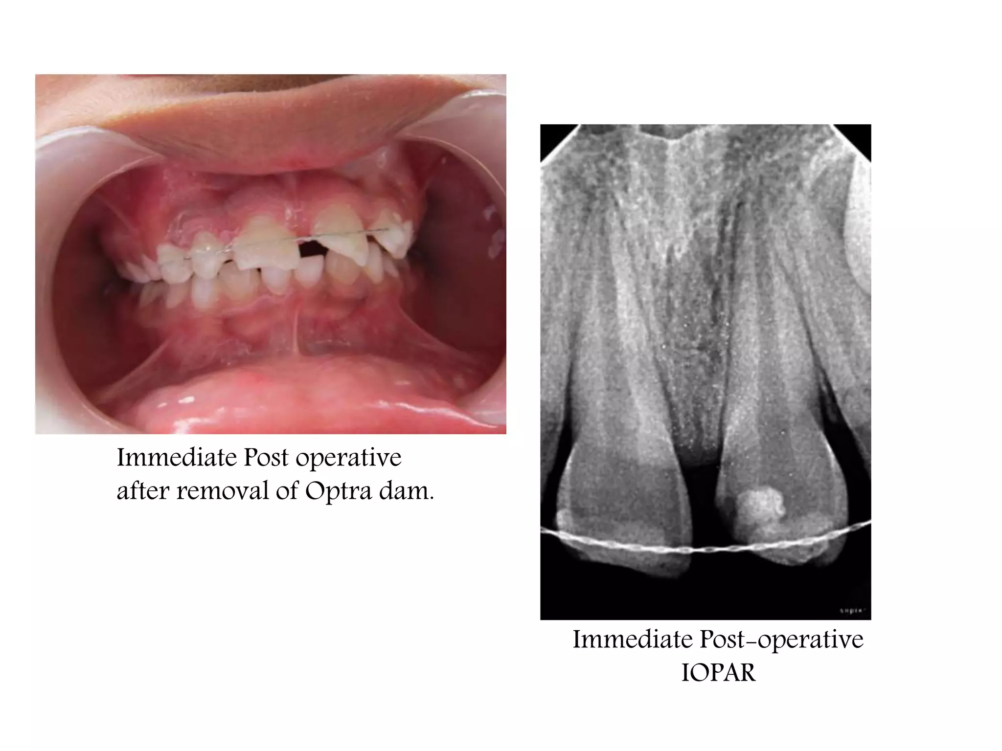 A case of cvek pulpotomy with mta | PPTX