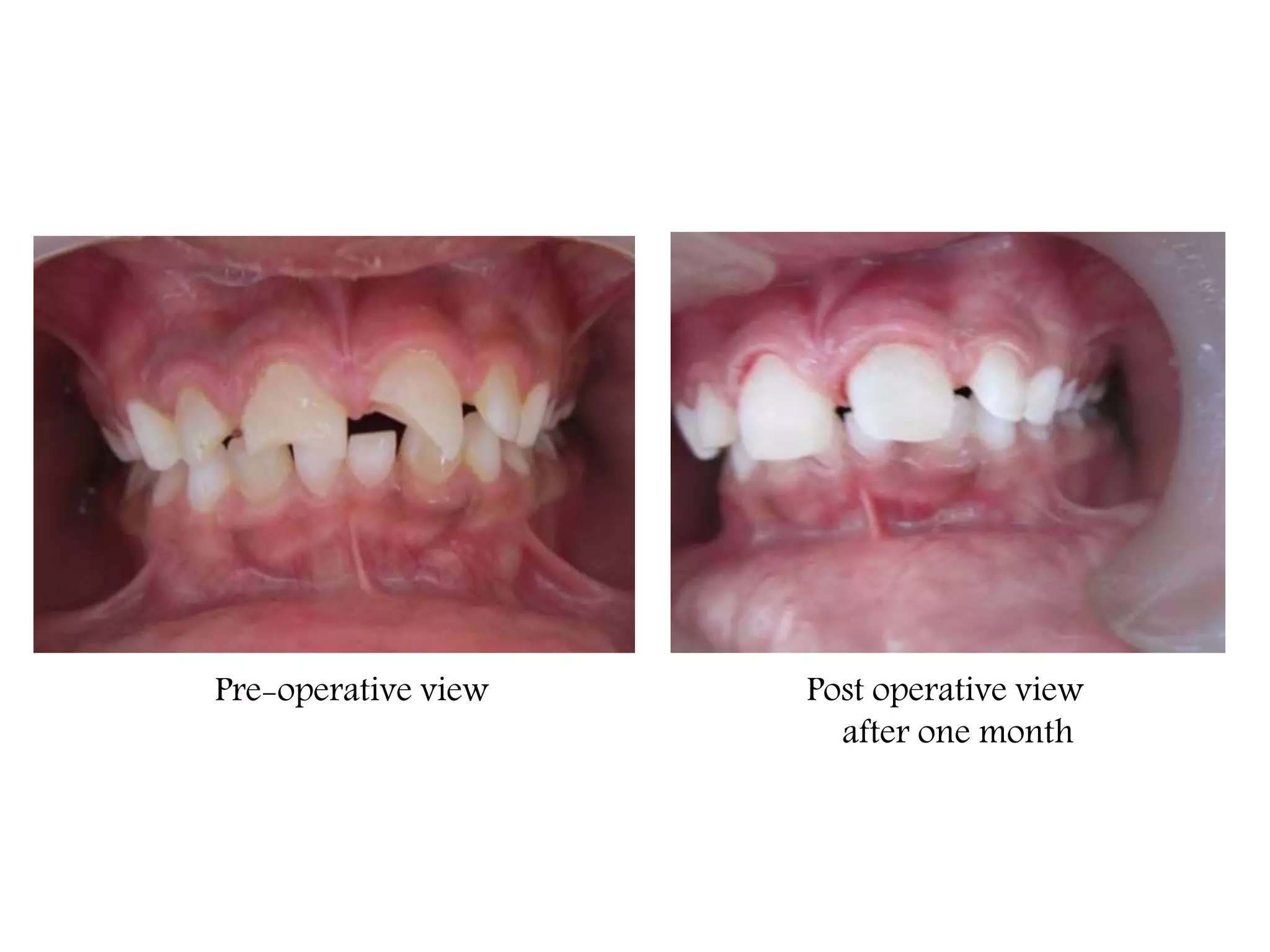 A case of cvek pulpotomy with mta | PPTX