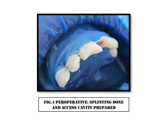 A case of cvek pulpotomy with mta | PPT
