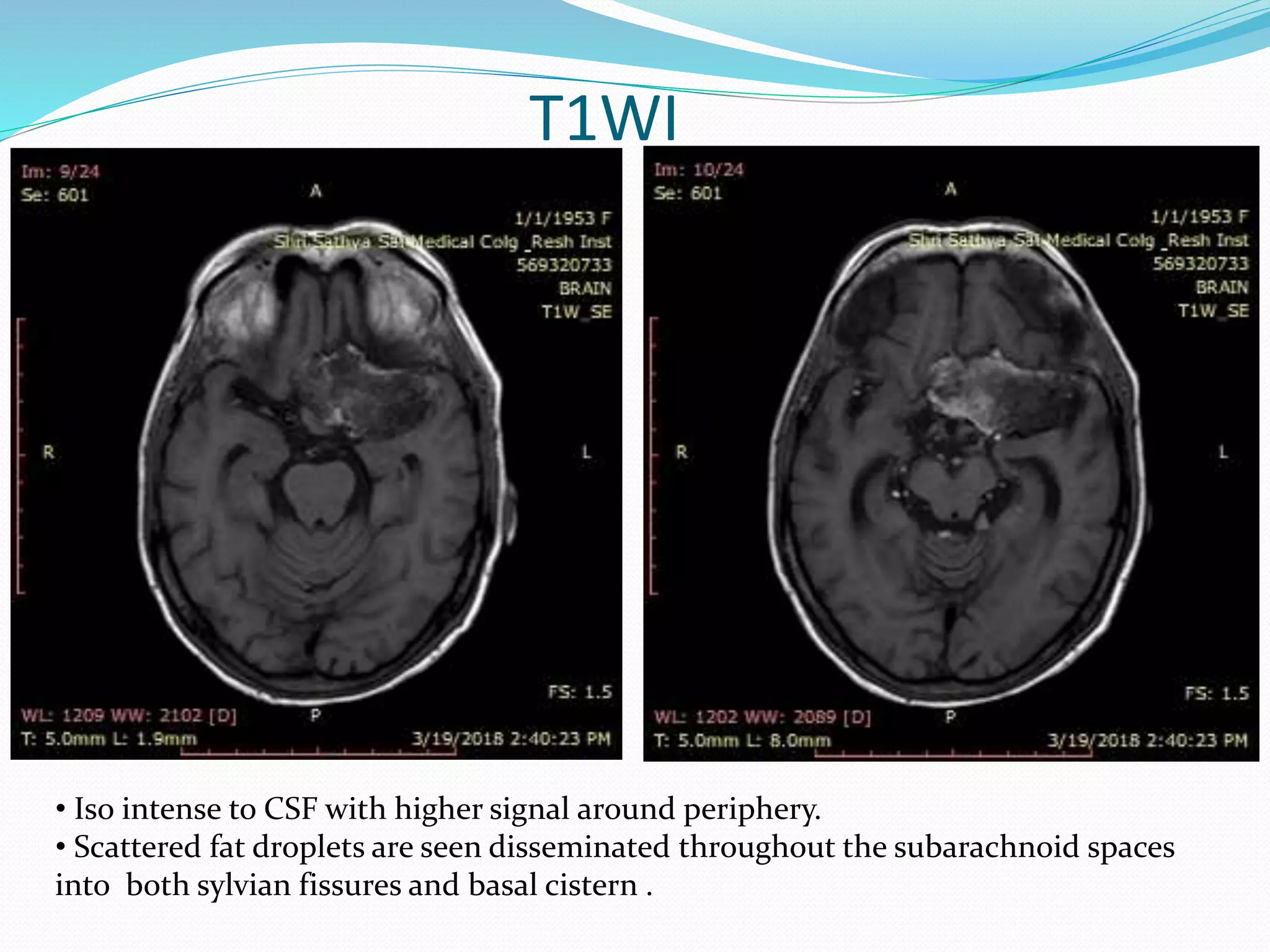 RUPTURED EPIDERMOID CYST | PPTX