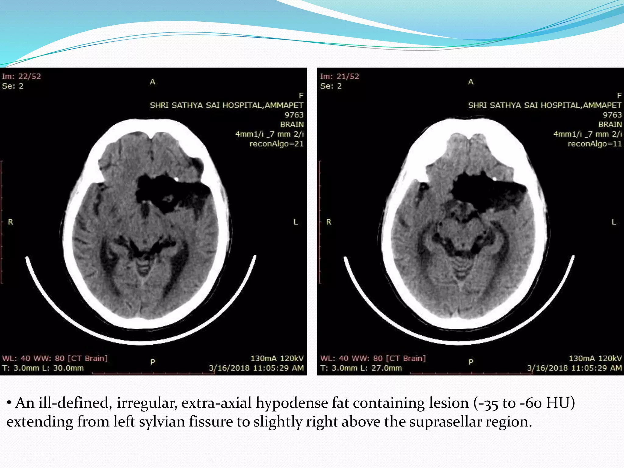 RUPTURED EPIDERMOID CYST | PPTX