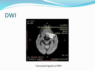 RUPTURED EPIDERMOID CYST | PPT