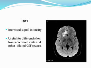 RUPTURED EPIDERMOID CYST | PPT