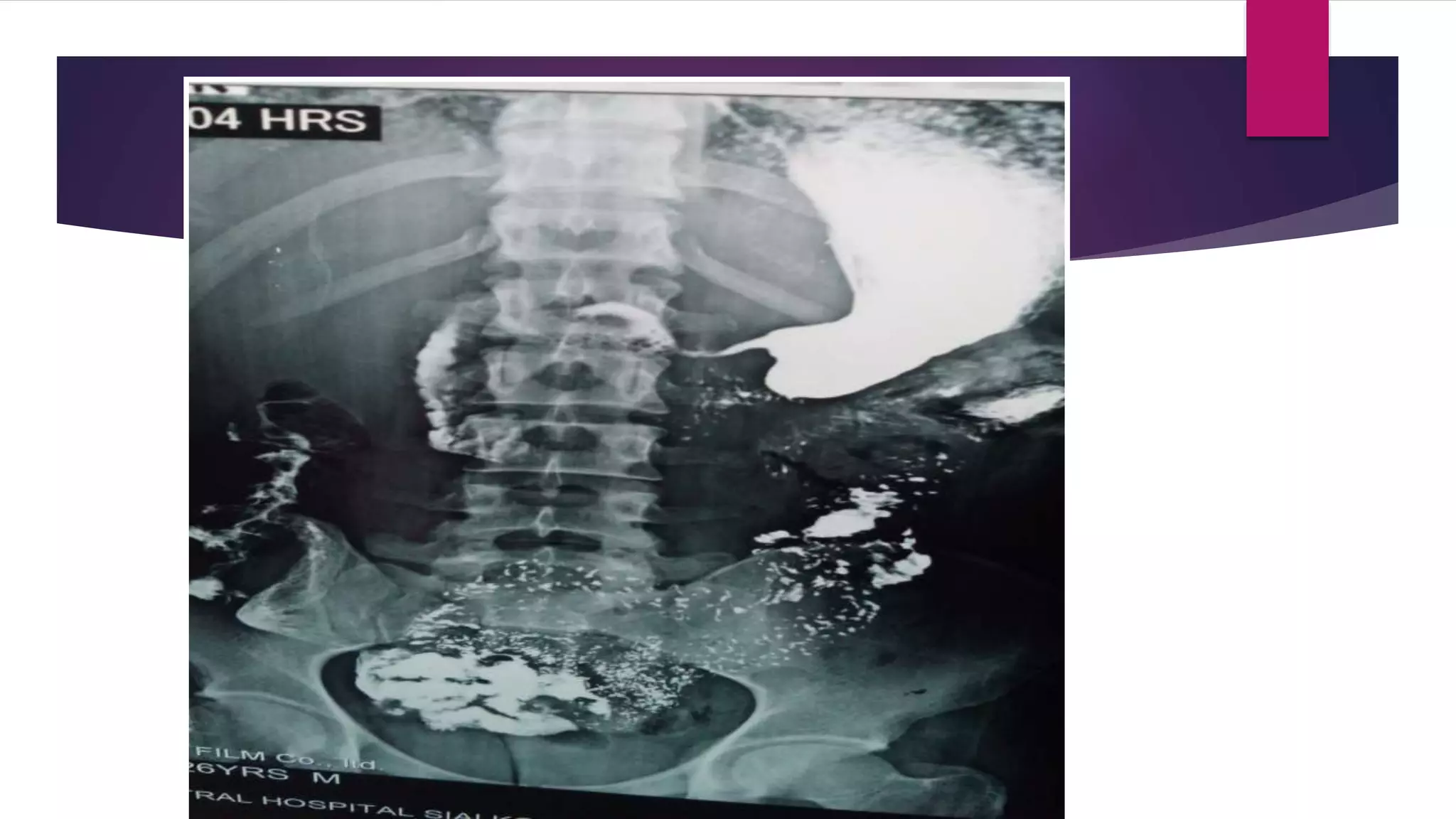 A Case Of Dysphagia- Stricture Esophagus.pptx