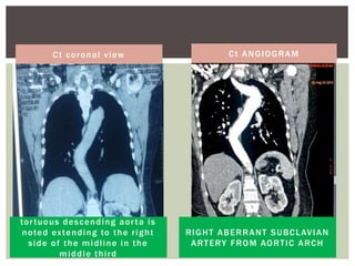 A case of dysphagia lusoria | PPTX