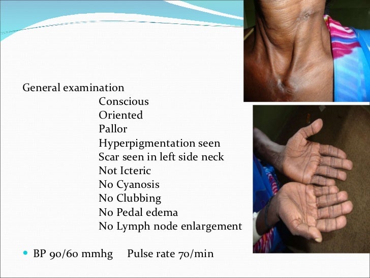 Poems Syndrome Causes Survival Rate Treatment